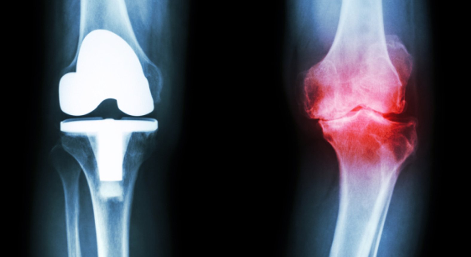 OA Dr. Philipp Grabowiecki - Gonarthrose/Knieprothese | Orthopäde in ...