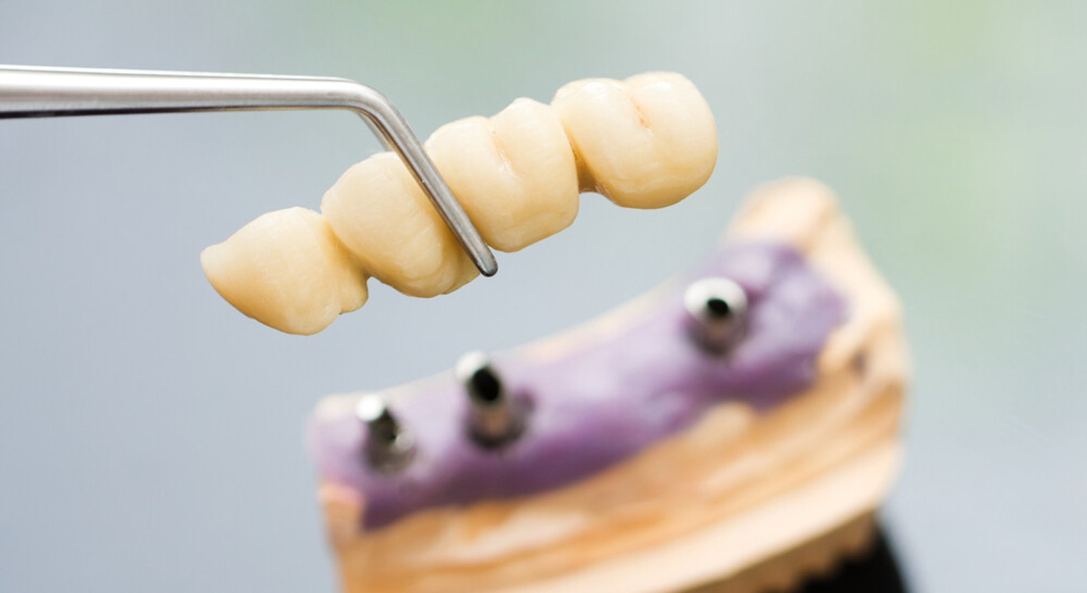 DDr. Andreas Pinter - Kronen- und Brückenversorgung | Zahnarzt in 1180 ...