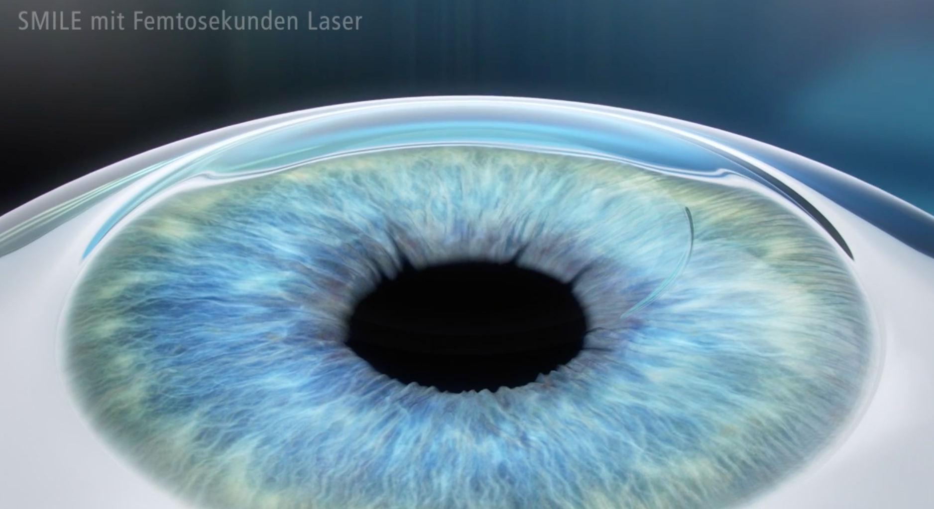 Priv.-Doz. Dr. Dr. Nikolaus Luft, FEBO - Relex SMILE | Augenarzt in ...