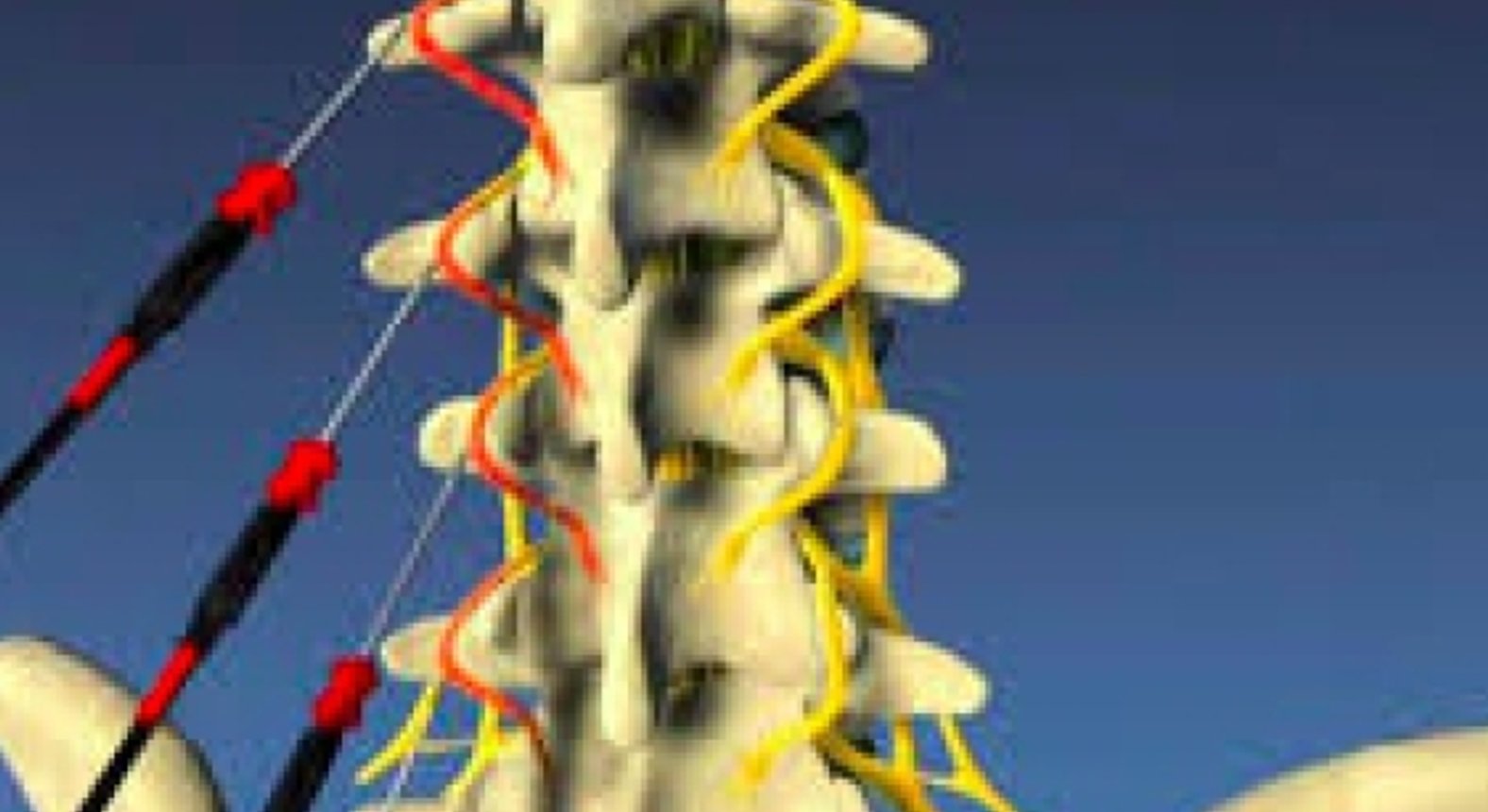 OA Dr. med. Nazem Atassi - Thermokoagulation bei chronischen ...