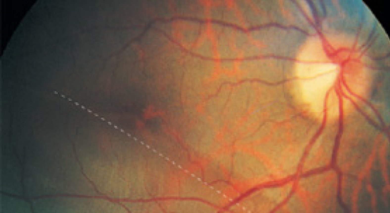 Univ.-Prof. Dr. Mathias Zirm - Laserbehandlung der Netzhaut | Augenarzt ...