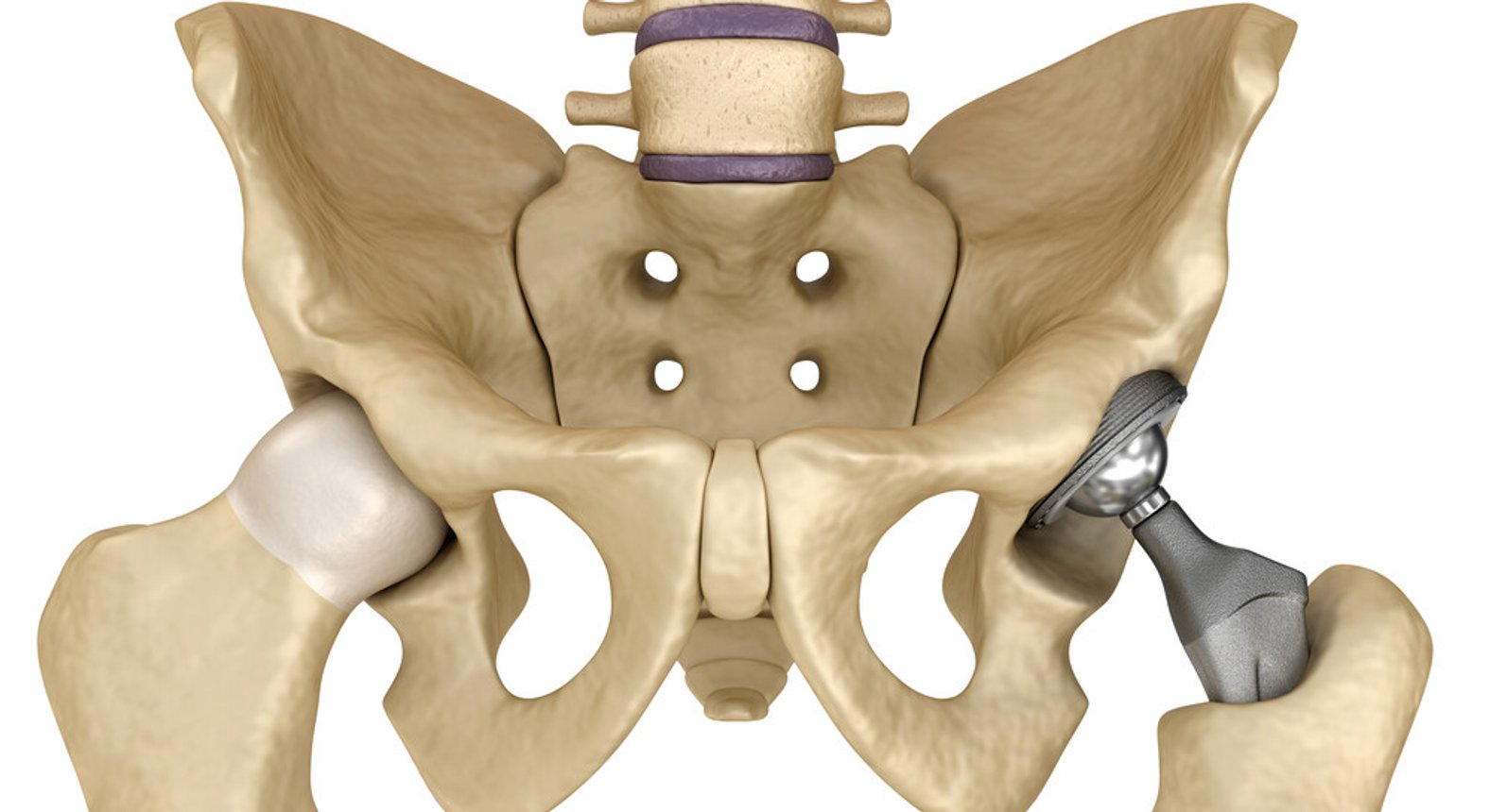 OA Dr. Thomas Kolp - Hüfttotalendoprothese (Hüft-TEP) | Orthopäde in ...