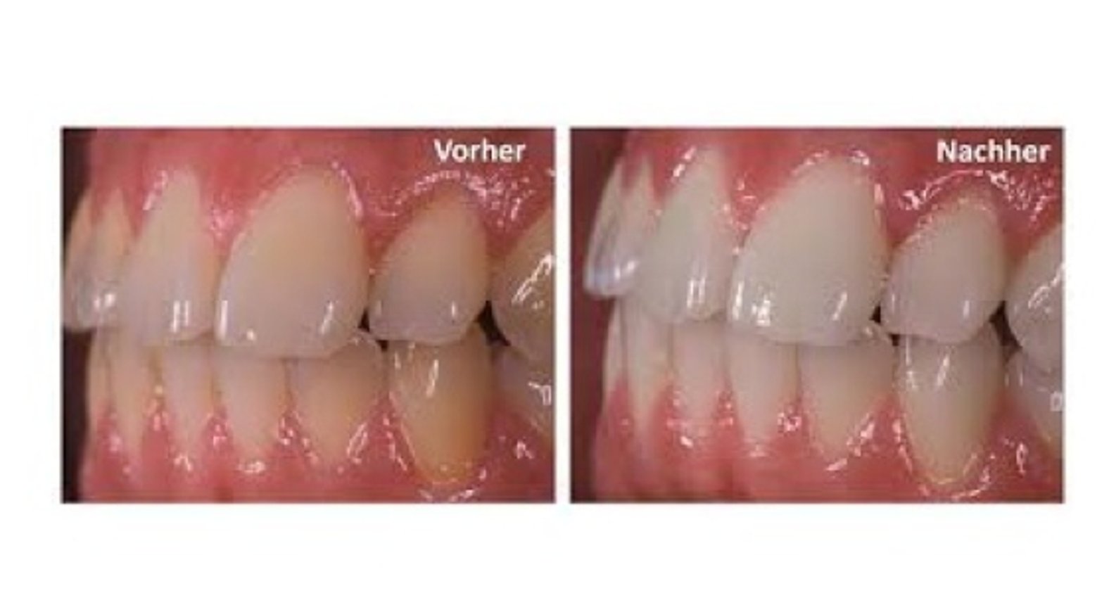 DDr. Barbara Ferra - Professionelle Zahnaufhellung - Bleaching ...