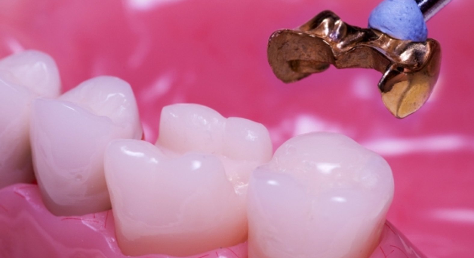 Dr. Behfar Basharat - Kronen (Zahnersatz aus Vollkeramik) | Zahnarzt in 1150 Wien - DocFinder.at