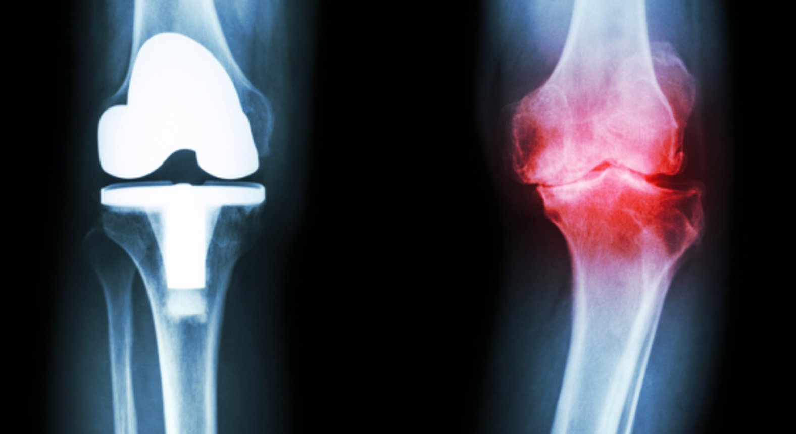 OA Dr. Hans Peter Heuberger - Knieprothese | Orthopäde in 2700 Wiener ...