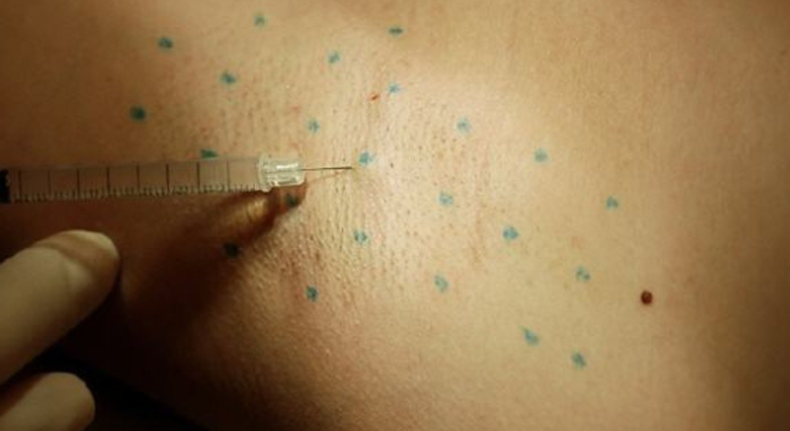 Dr. Andrea Luidold - Hyperhidrose: Behandlung von übermäßigem Schwitzen ...